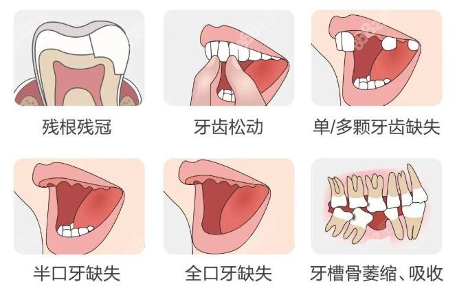 麻阳雅贝康口腔价格贵吗？不贵啊，种植牙3980+/矫正7000+,牙齿矫正-8682整形网