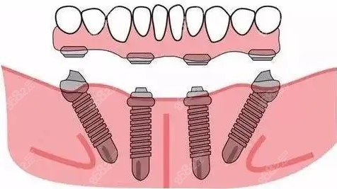 铜仁种植牙多少钱一颗?参考铜仁种植牙齿价格表种牙4980+/颗,种植牙-8682整形网