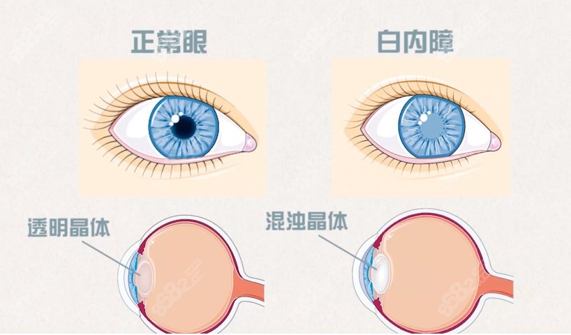 美国眼力健zmb00晶体的优缺点介绍:附zmb00说明书/价格和参数,近视眼矫正-8682整形网