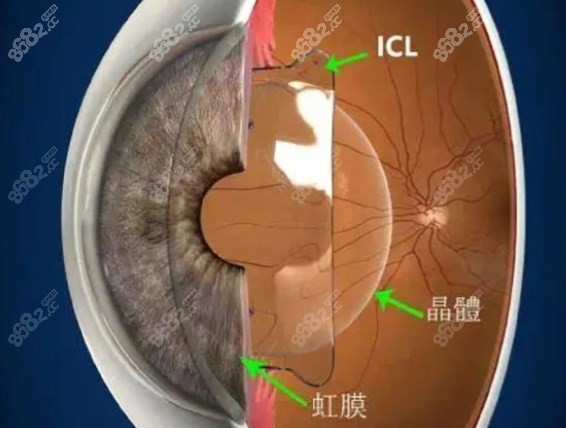 廉井财和李海燕哪个做icl晶体植入时间久?PK手术量及技术,近视眼矫正-8682整形网